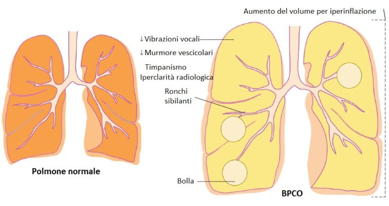 La BroncoPneumopatia Cronica Ostruttiva (BPCO) - Bald Mountain Science