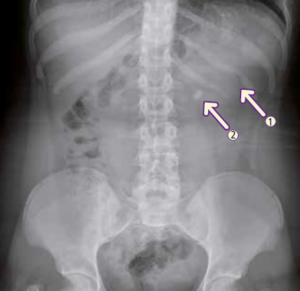 La radiografia diretta dell’addome – Bald Mountain Science