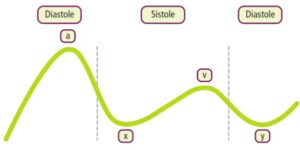 Semeiotica cardiovascolare: analisi e fisiopatologia del polso venoso ...