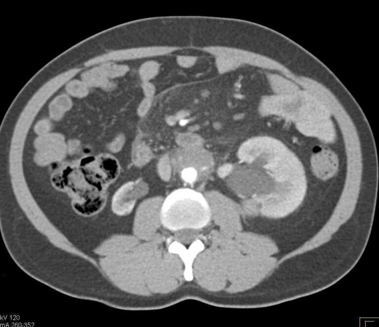 Cause, diagnosi e trattamento della fibrosi retroperitoneale – Bald ...